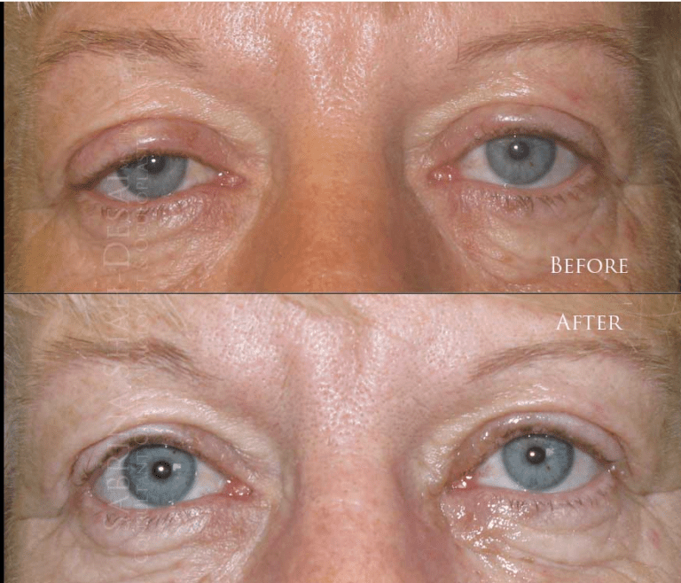 Ptosis Surgery Before & After | London, UK - PEL