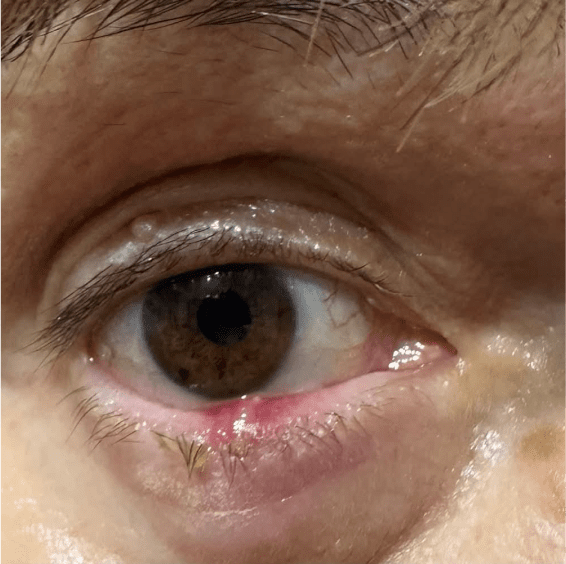 Eyelid Cancer - Perfect Eyes Ltd