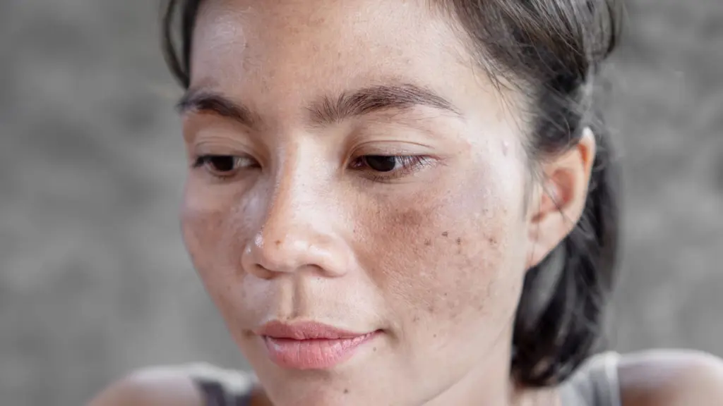 Beginning Stages of Eye Stye: The Early Phases and Treatment