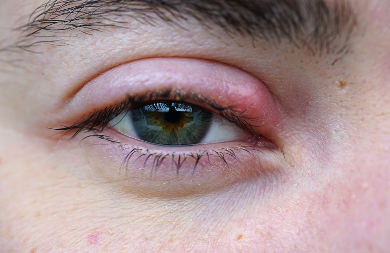 Beginning Stages of Eye Stye: The Early Phases and Treatment