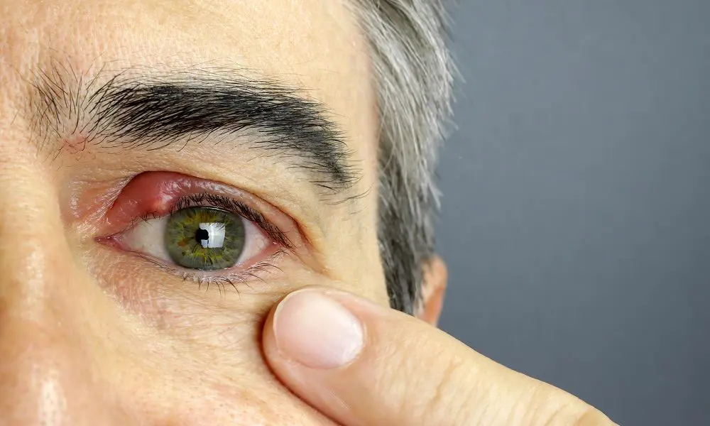 Stye Inside Eyelid: Causes, Symptoms and Expert Treatments